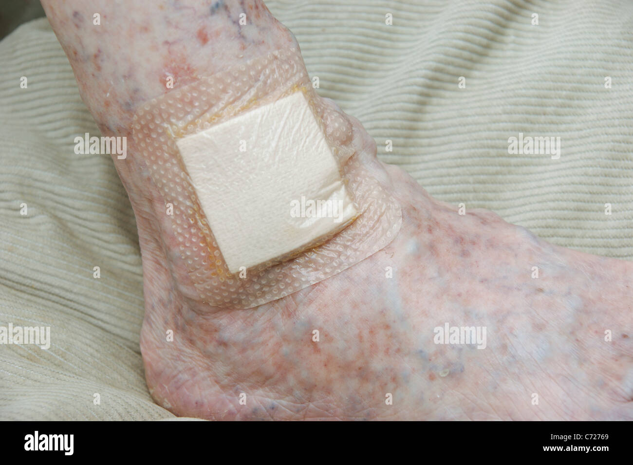 Infected wound hi-res stock photography and images - Alamy