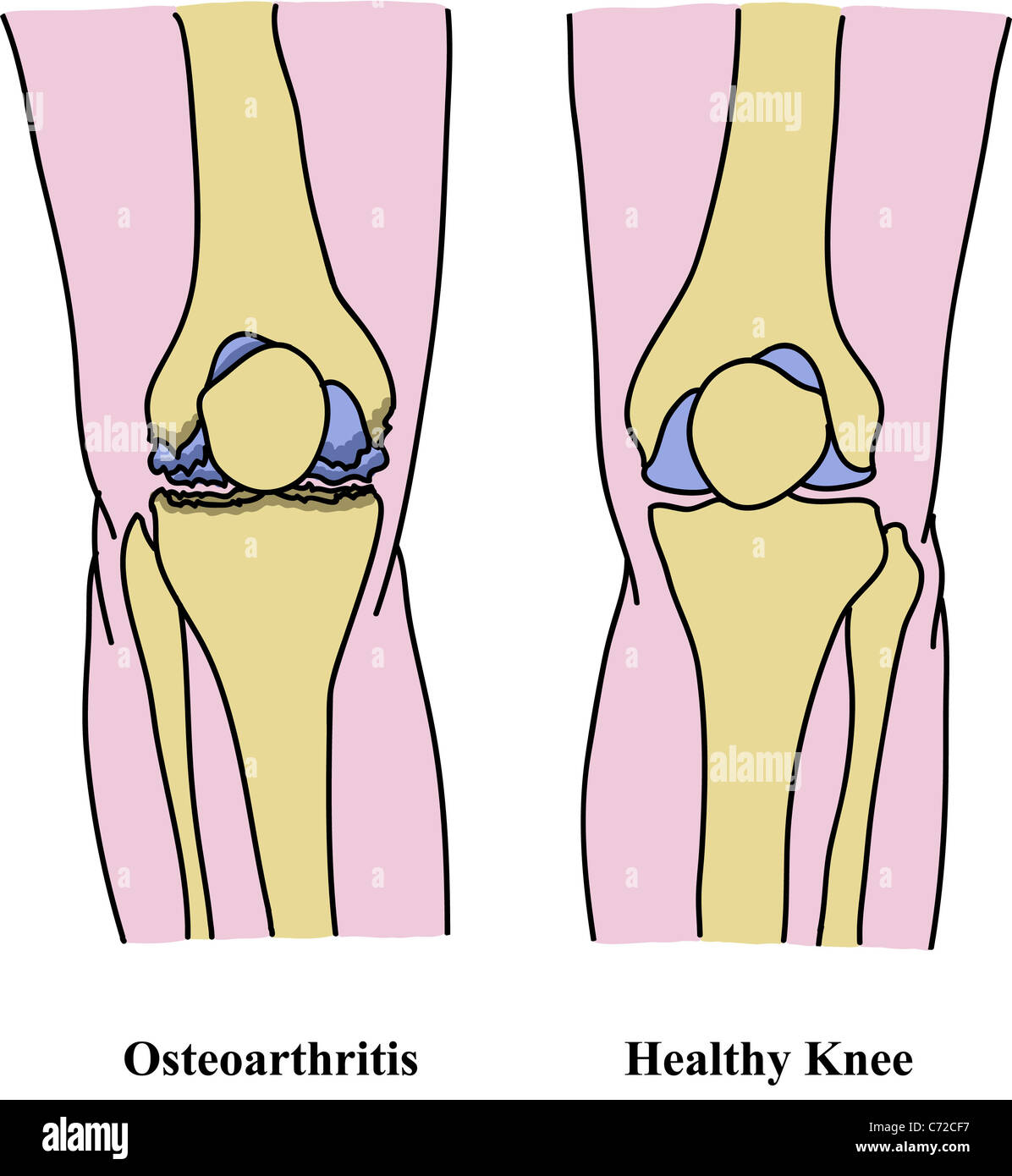Knee osteoarthritis drawing hi-res stock photography and images - Alamy