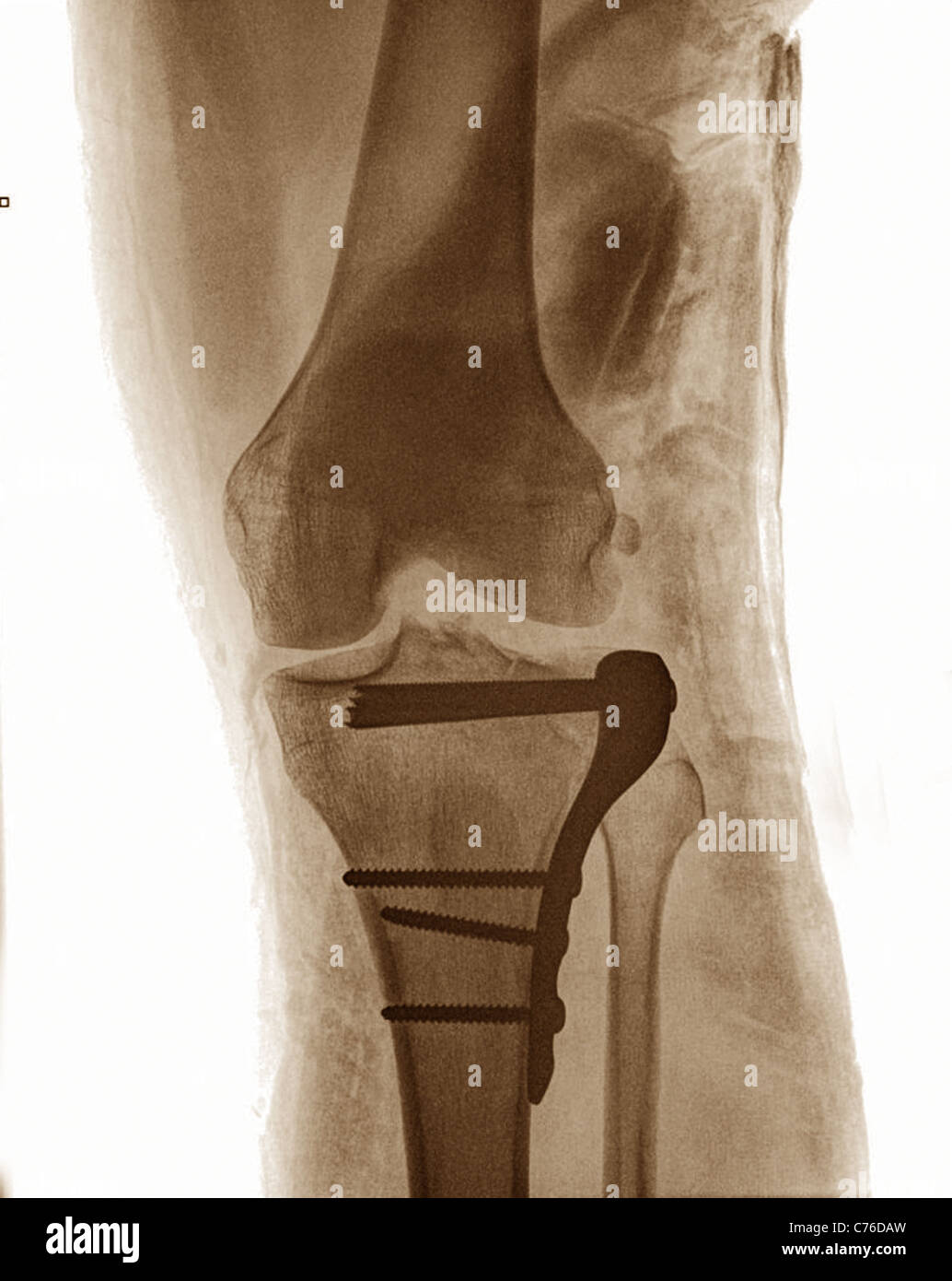 Operation to repair a fractured knee joint (see also x-ray images of ...