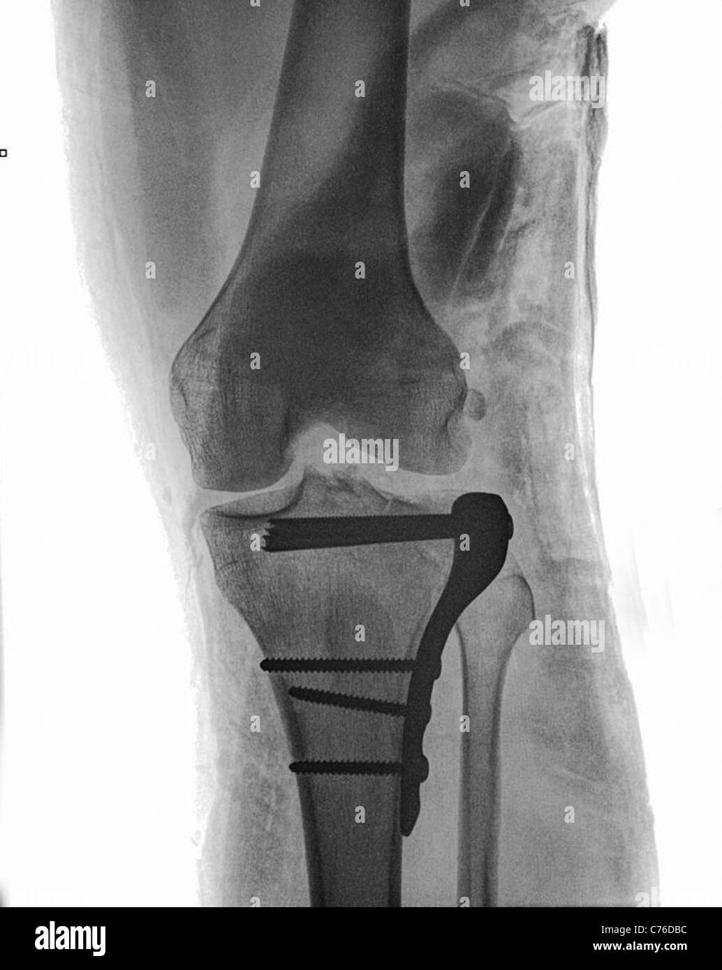 Tibia pins High Resolution Stock Photography and Images - Alamy