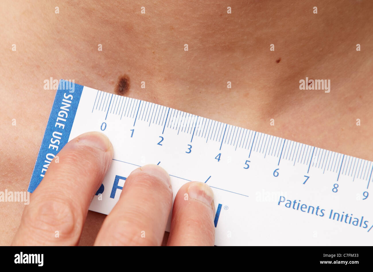 Close up of mole measurement Stock Photo - Alamy