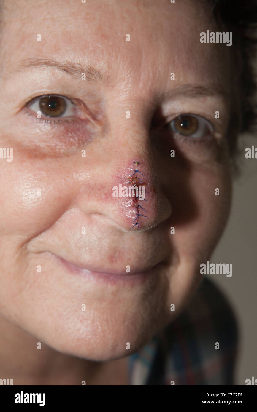 Nose sutures hi-res stock photography and images - Alamy