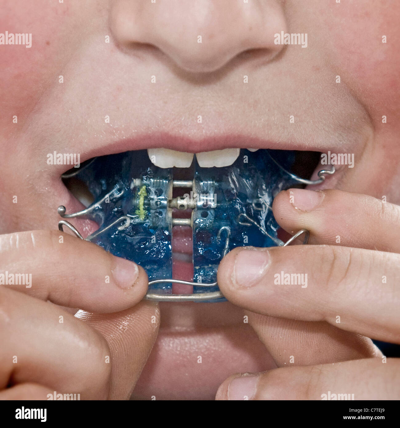 Boy putting on orthodontic braces Stock Photo - Alamy