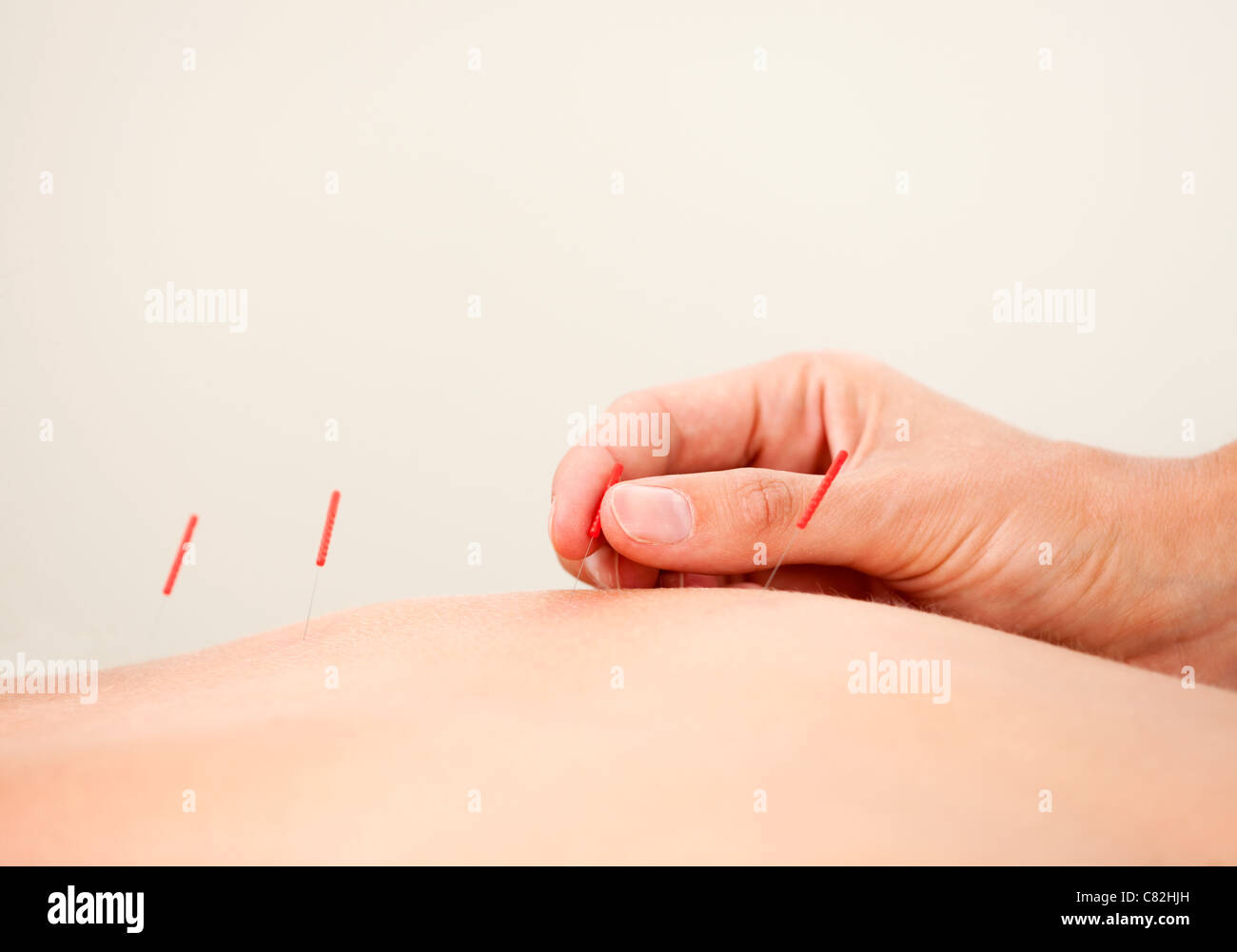 Female hand acupuncture needles hi-res stock photography and images - Alamy