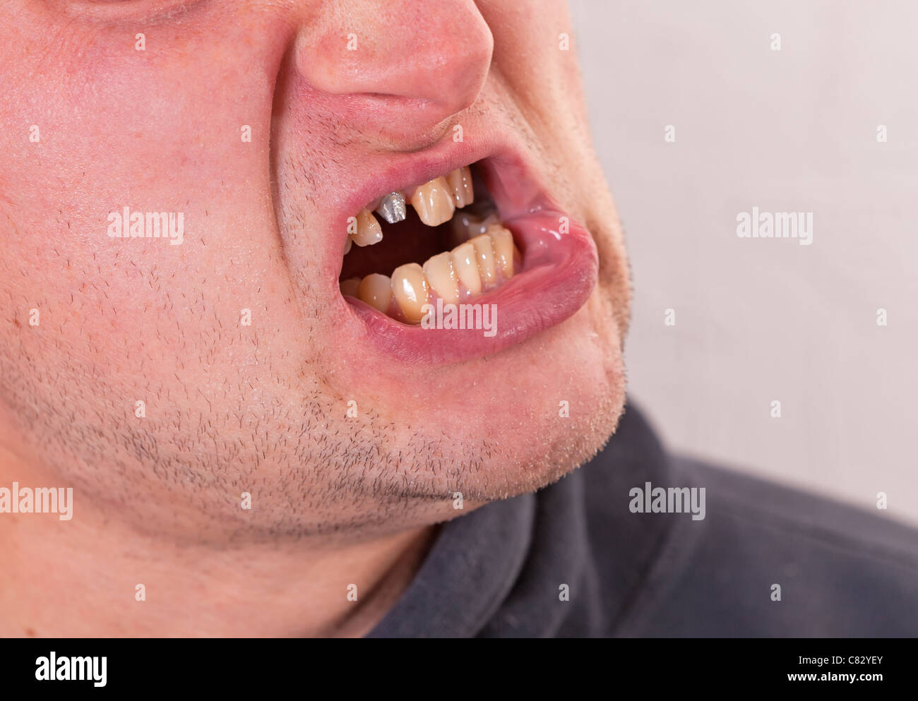 Rotten teeth hi-res stock photography and images - Alamy