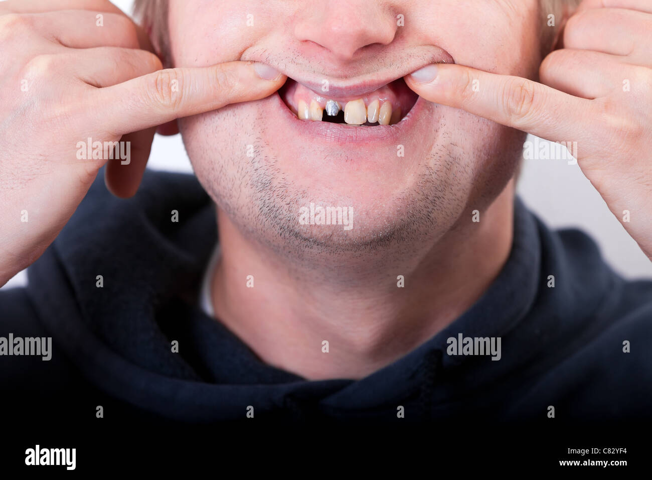 Broken tooth hi-res stock photography and images - Alamy