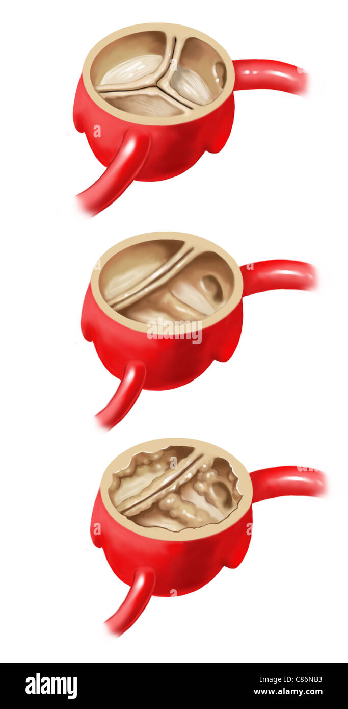 Aortic Valve High Resolution Stock Photography and Images - Alamy