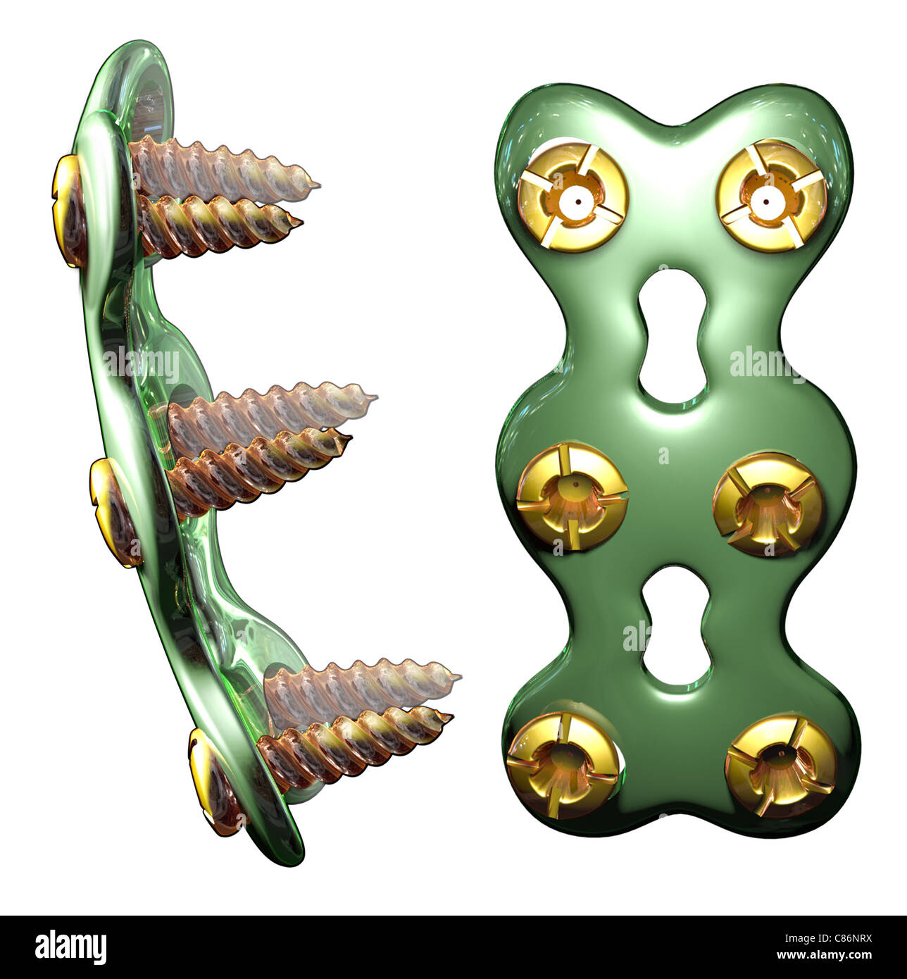 Anterior Cervical Fusion High Resolution Stock Photography and Images ...