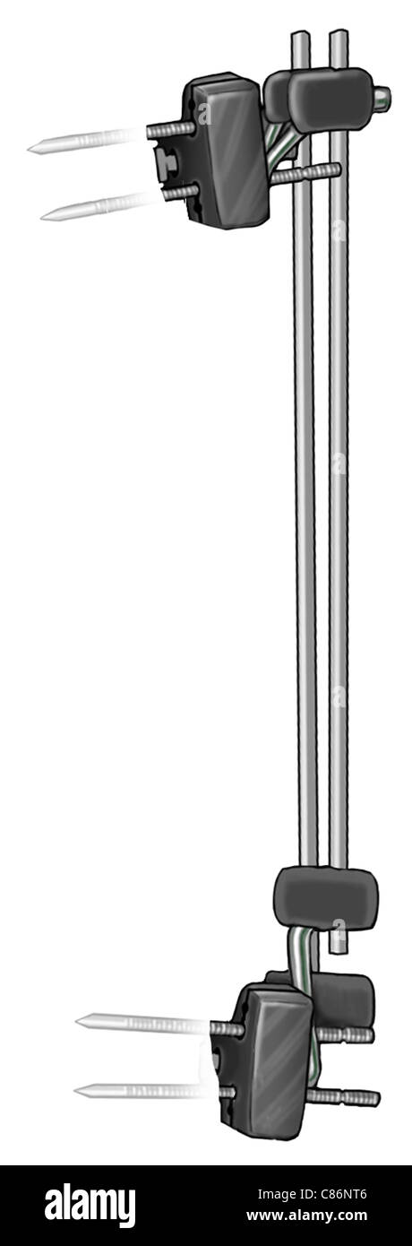 Leg External Fixator High Resolution Stock Photography and Images - Alamy