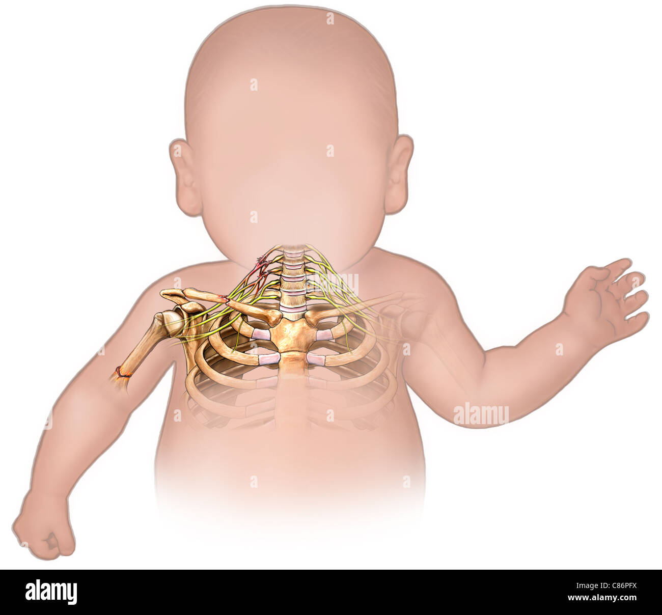 Brachial Plexus Injury High Resolution Stock Photography and Images - Alamy