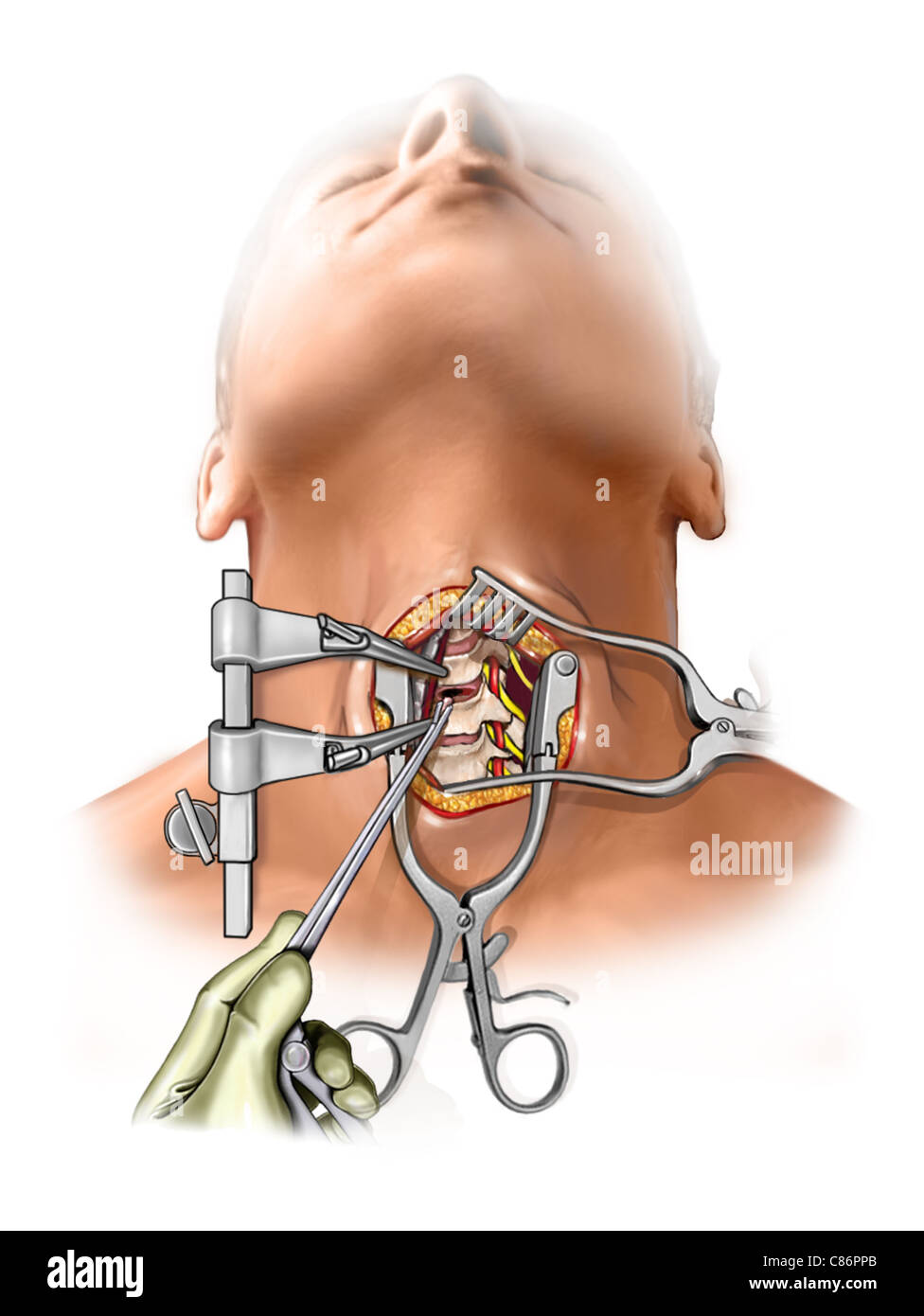 Anterior Cervical Discectomy High Resolution Stock Photography and ...
