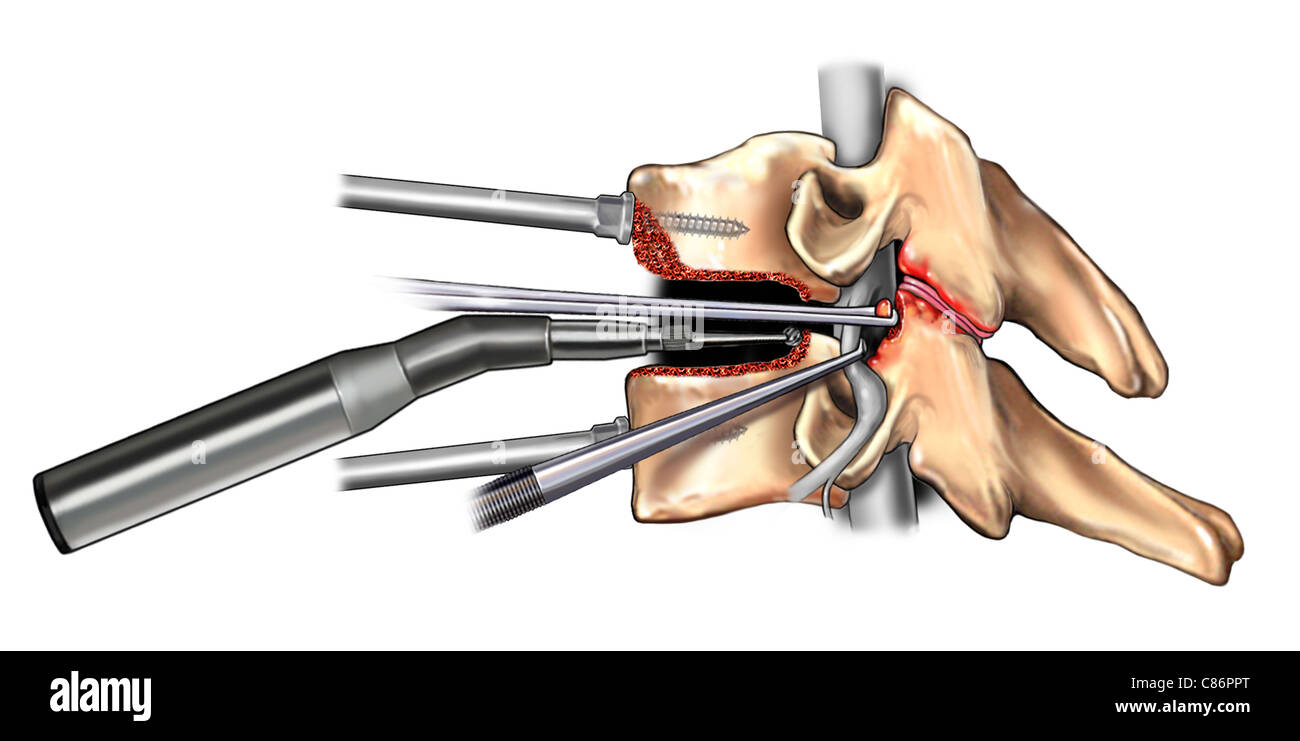 Cervical nucleus hi-res stock photography and images - Alamy