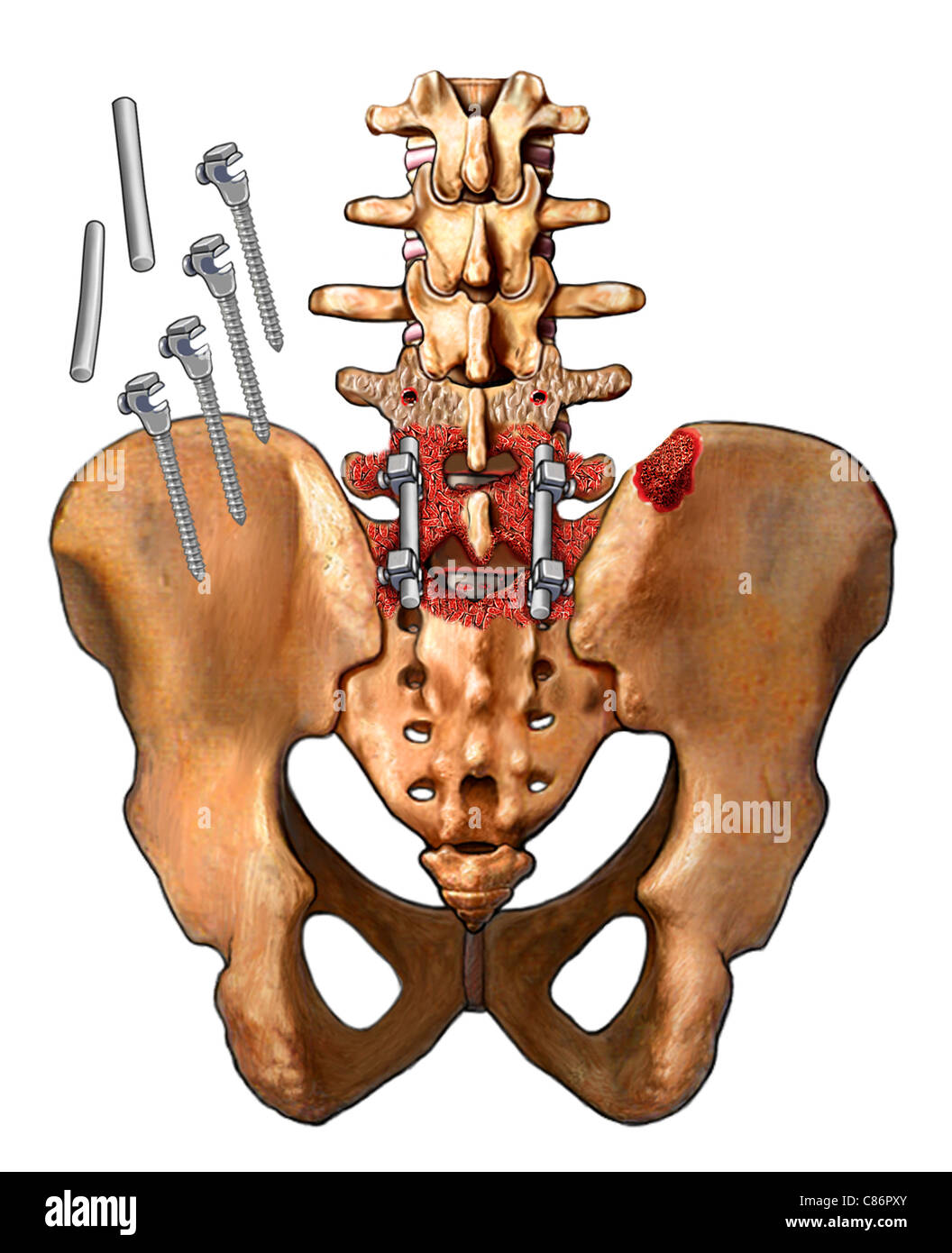 Pedicle screws hi-res stock photography and images - Alamy
