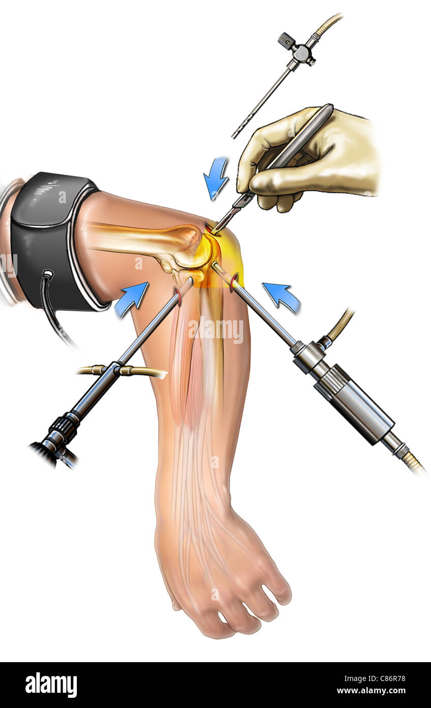 Arthroscope High Resolution Stock Photography and Images - Alamy