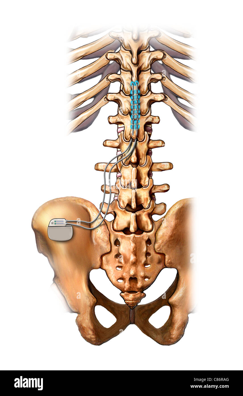 Spinal cord stimulator hi-res stock photography and images - Alamy