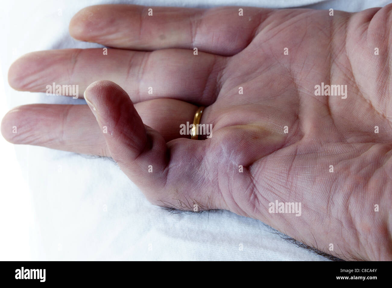 Dupuytrens contracture hand surgery hi-res stock photography and images ...