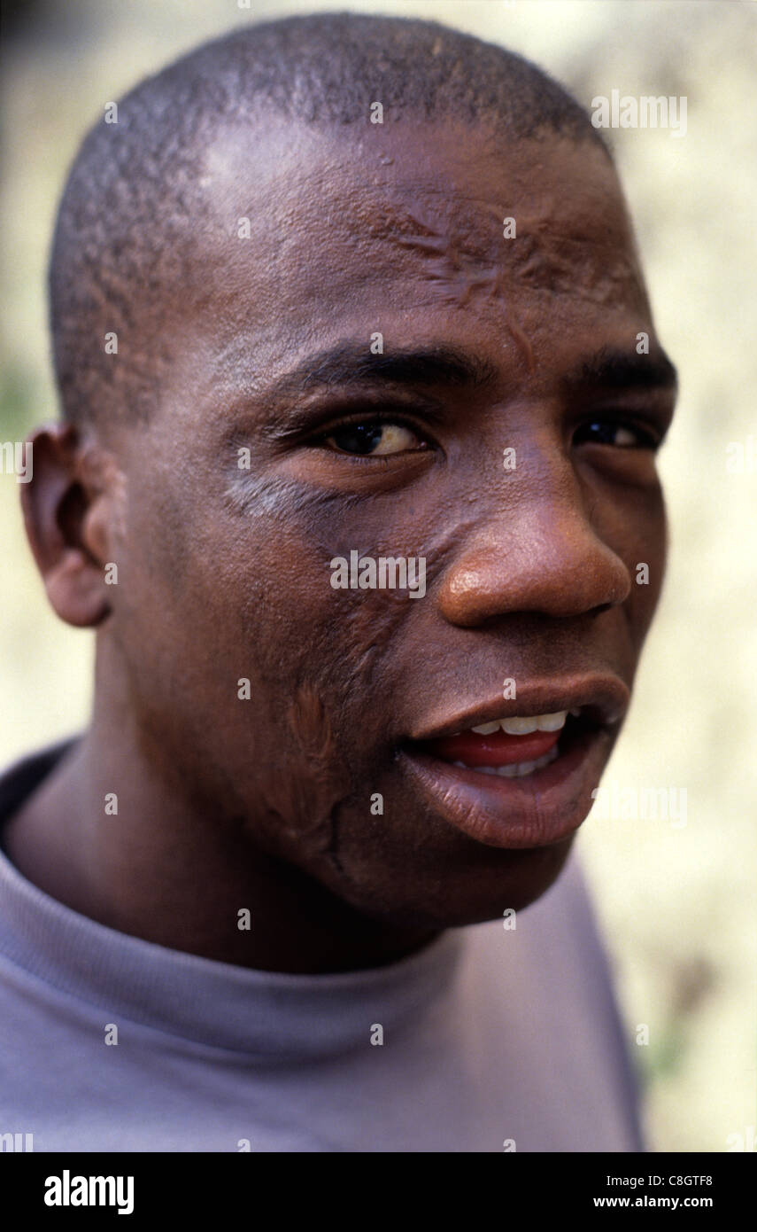 Rio de Janeiro, Brazil. Portrait of a black street kid with many burn ...