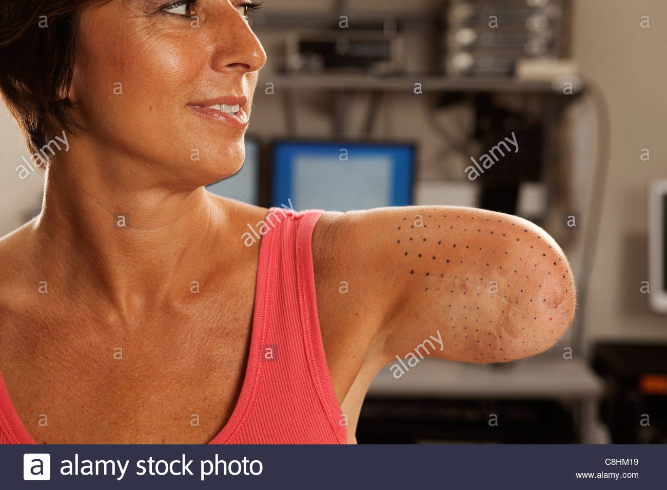 Woman Amputee Arm Stock Photos & Woman Amputee Arm Stock Images - Alamy