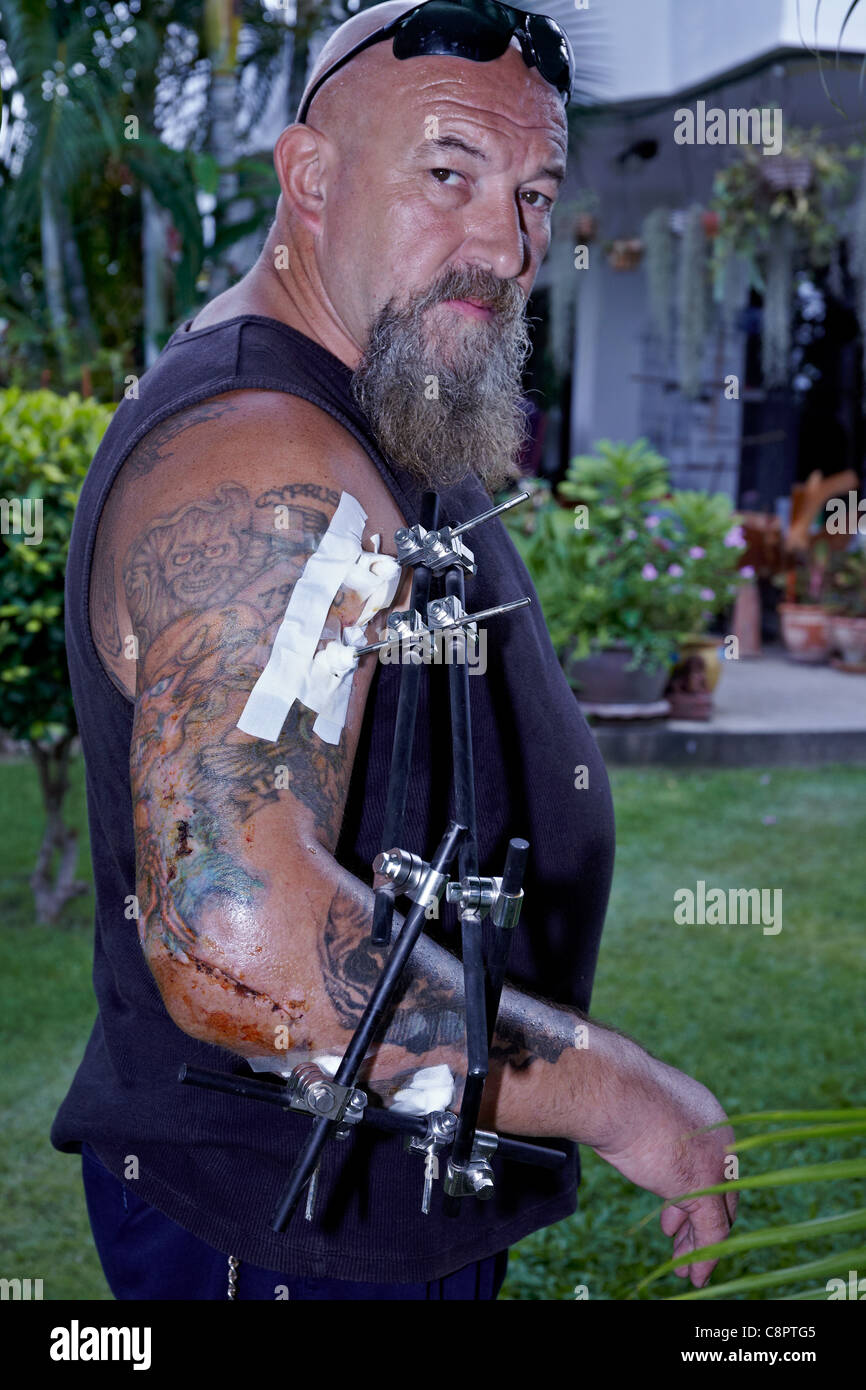 External fixator hi-res stock photography and images - Alamy