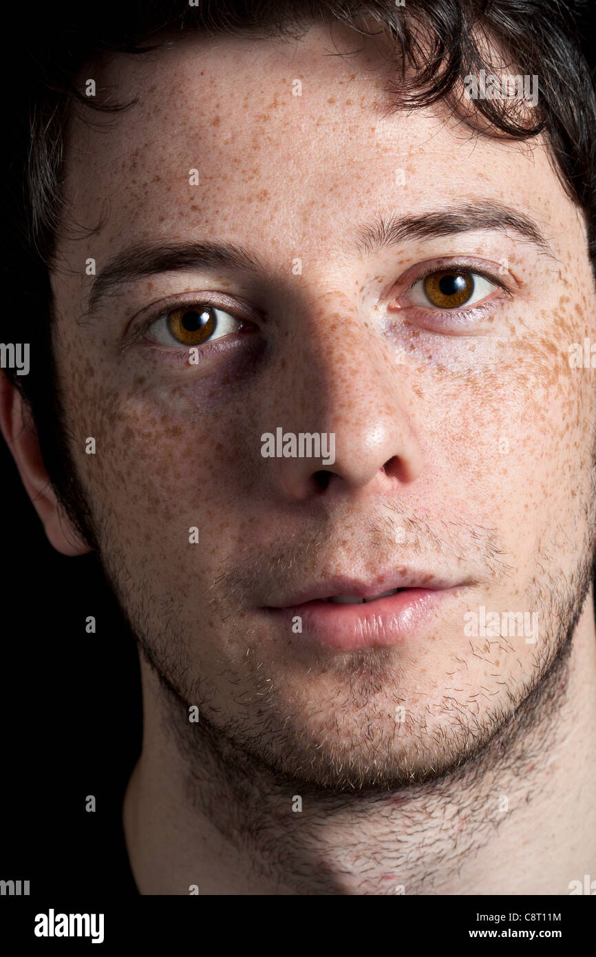 Man with Freckles Stock Photo - Alamy