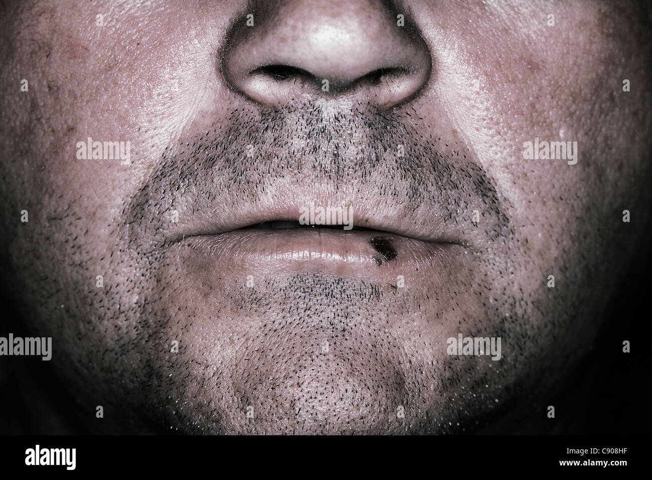 Face scab hi-res stock photography and images - Alamy
