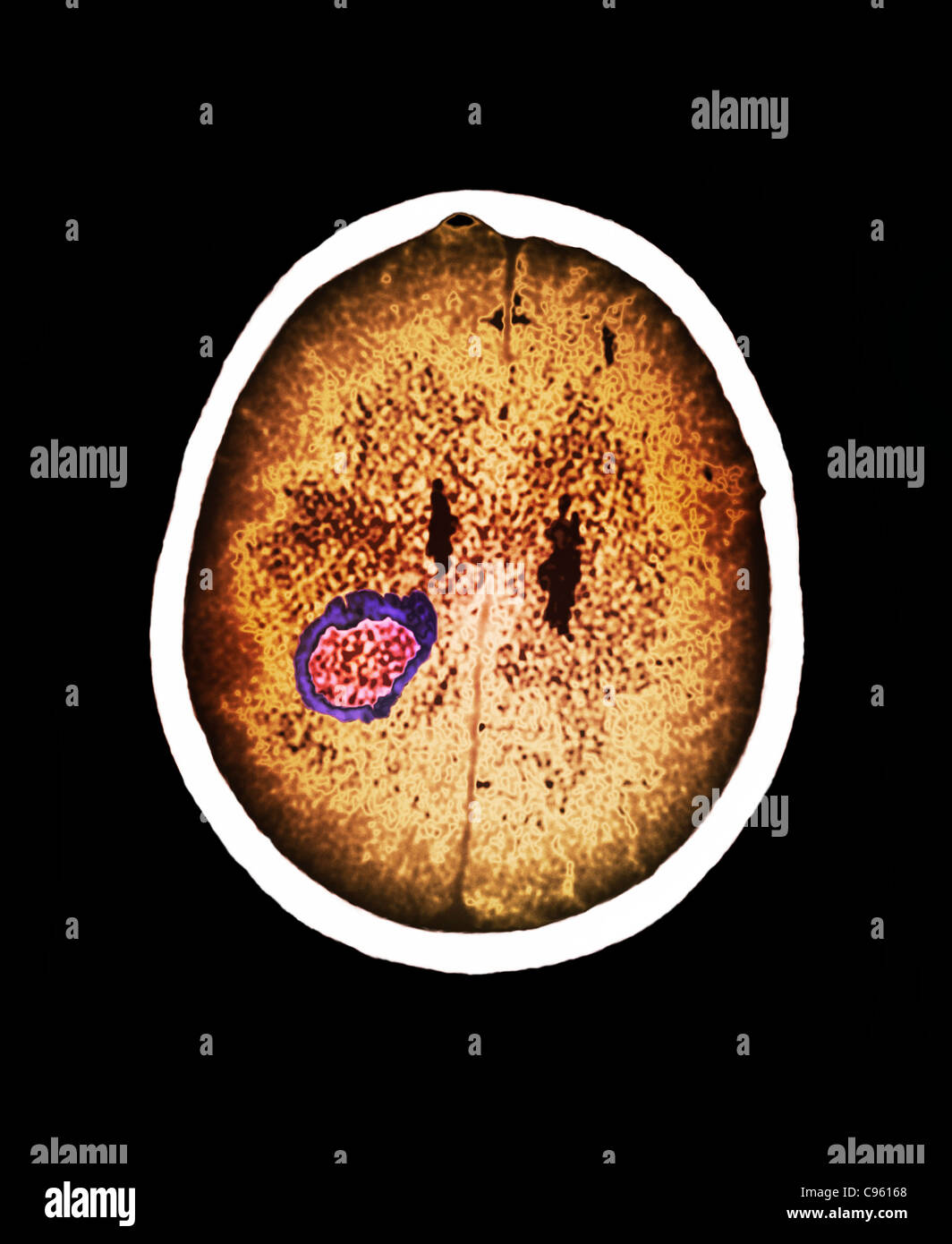 Brain abscess, CT scan Stock Photo - Alamy