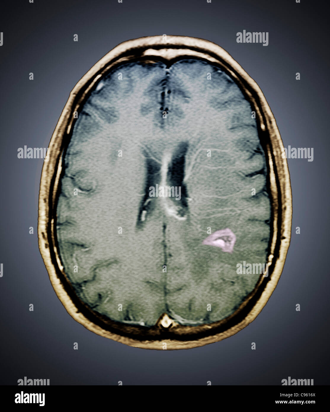Tapeworms In Humans Brain