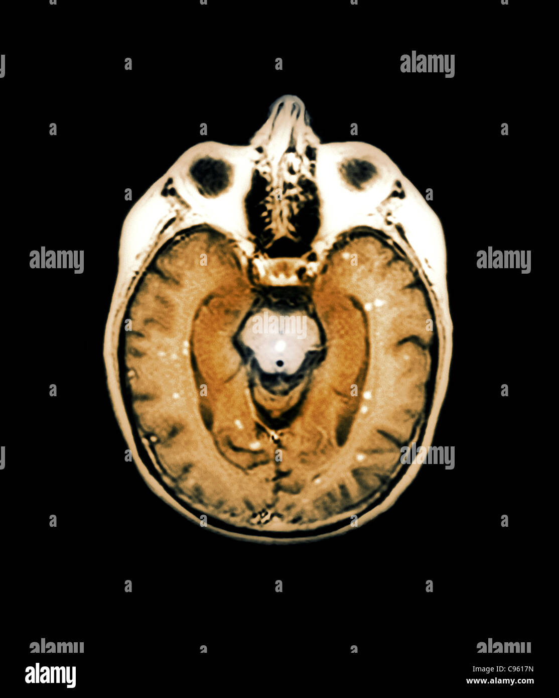 Secondary brain cancer, MRI scan Stock Photo - Alamy