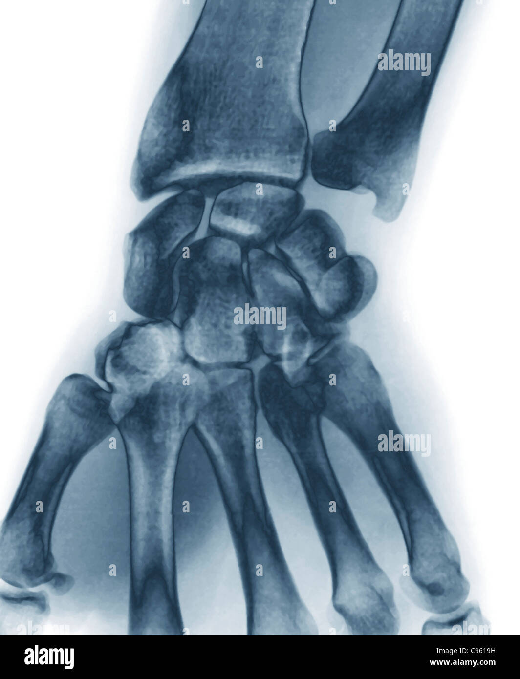 Normal Wrist X Ray Lateral