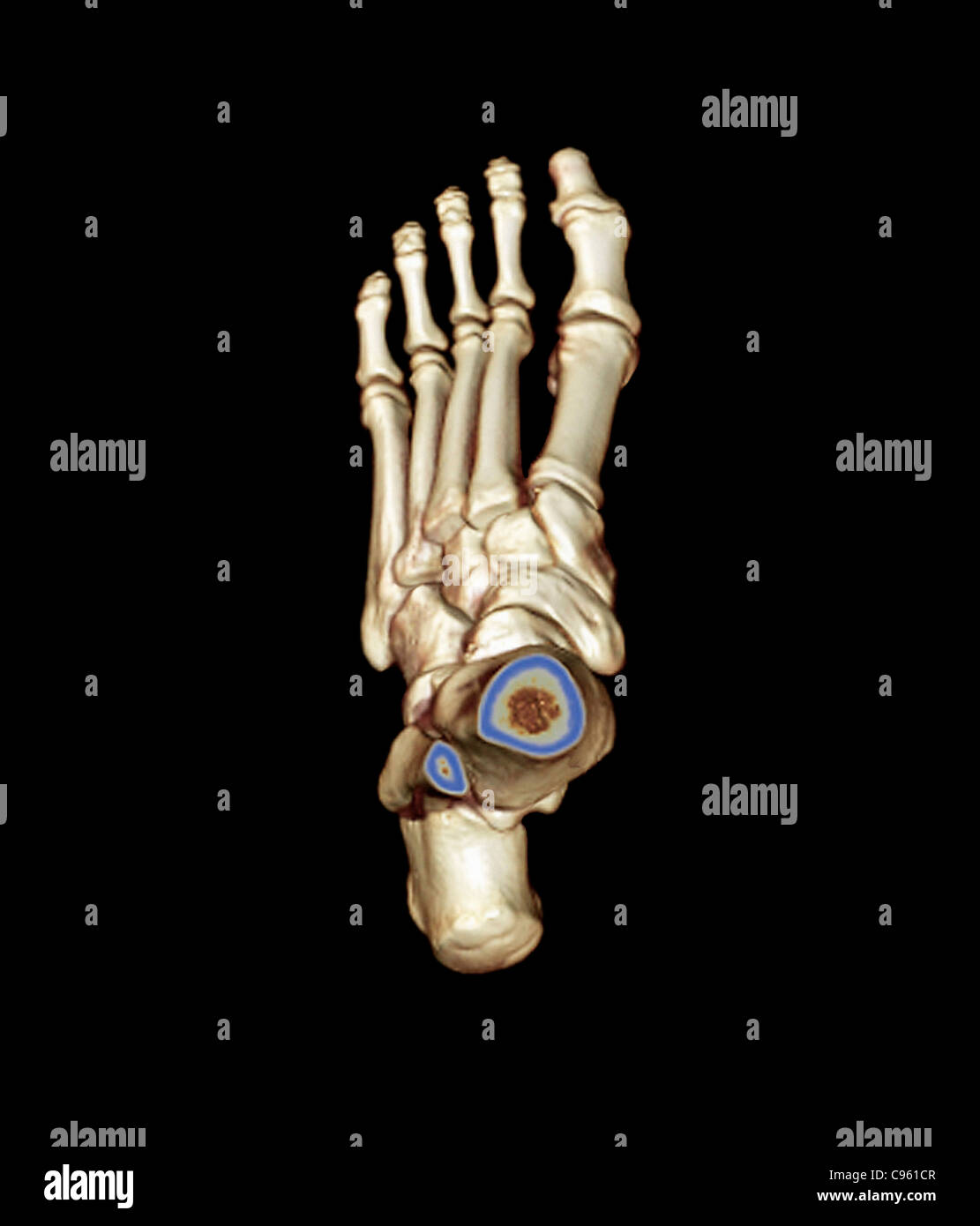 Normal foot. Coloured 3D computed tomography (CT) scan of the healthy ...