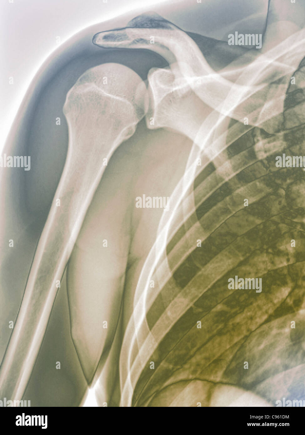 Normal shoulder x ray hi-res stock photography and images - Alamy