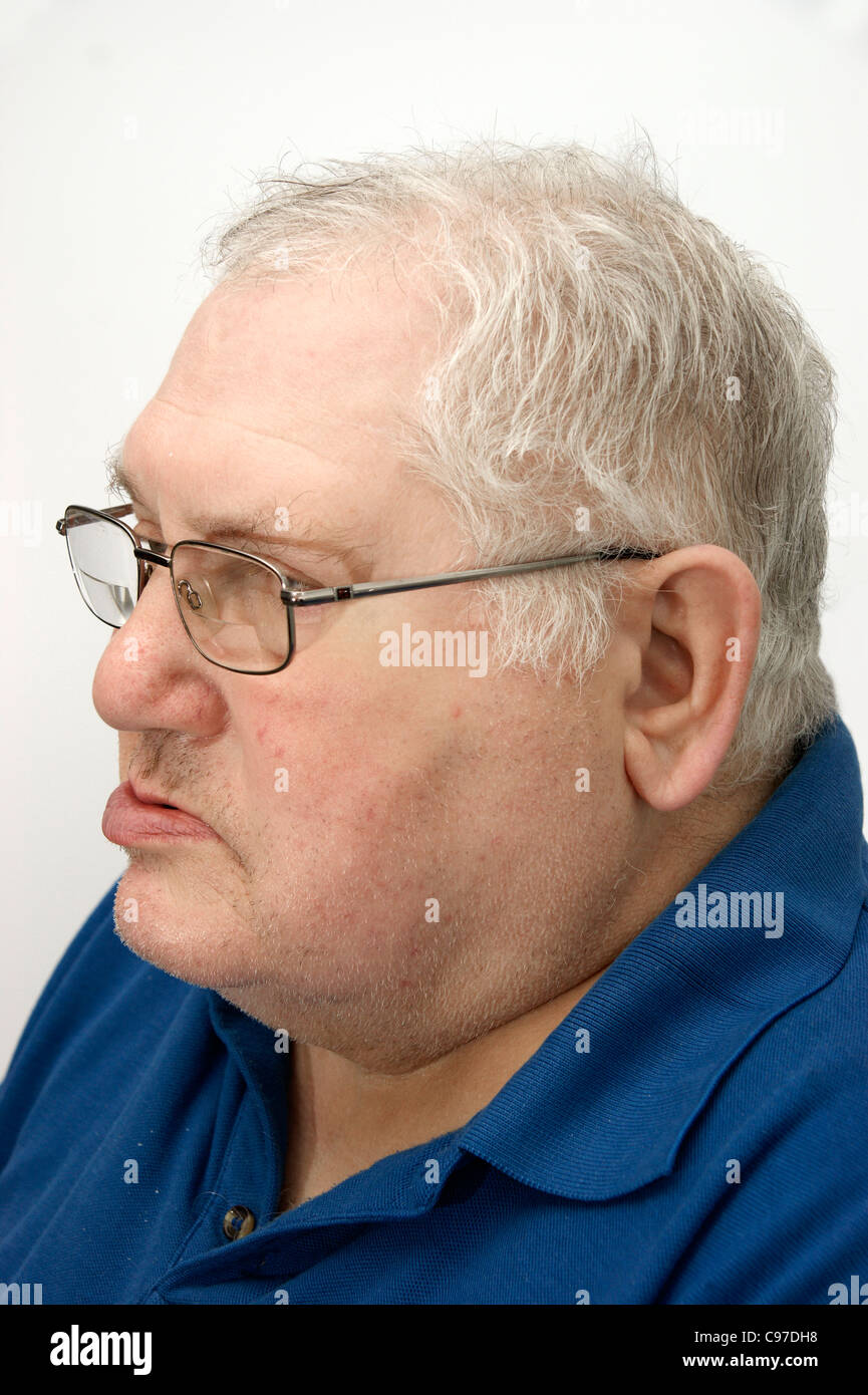 Bell's palsy hi-res stock photography and images - Alamy