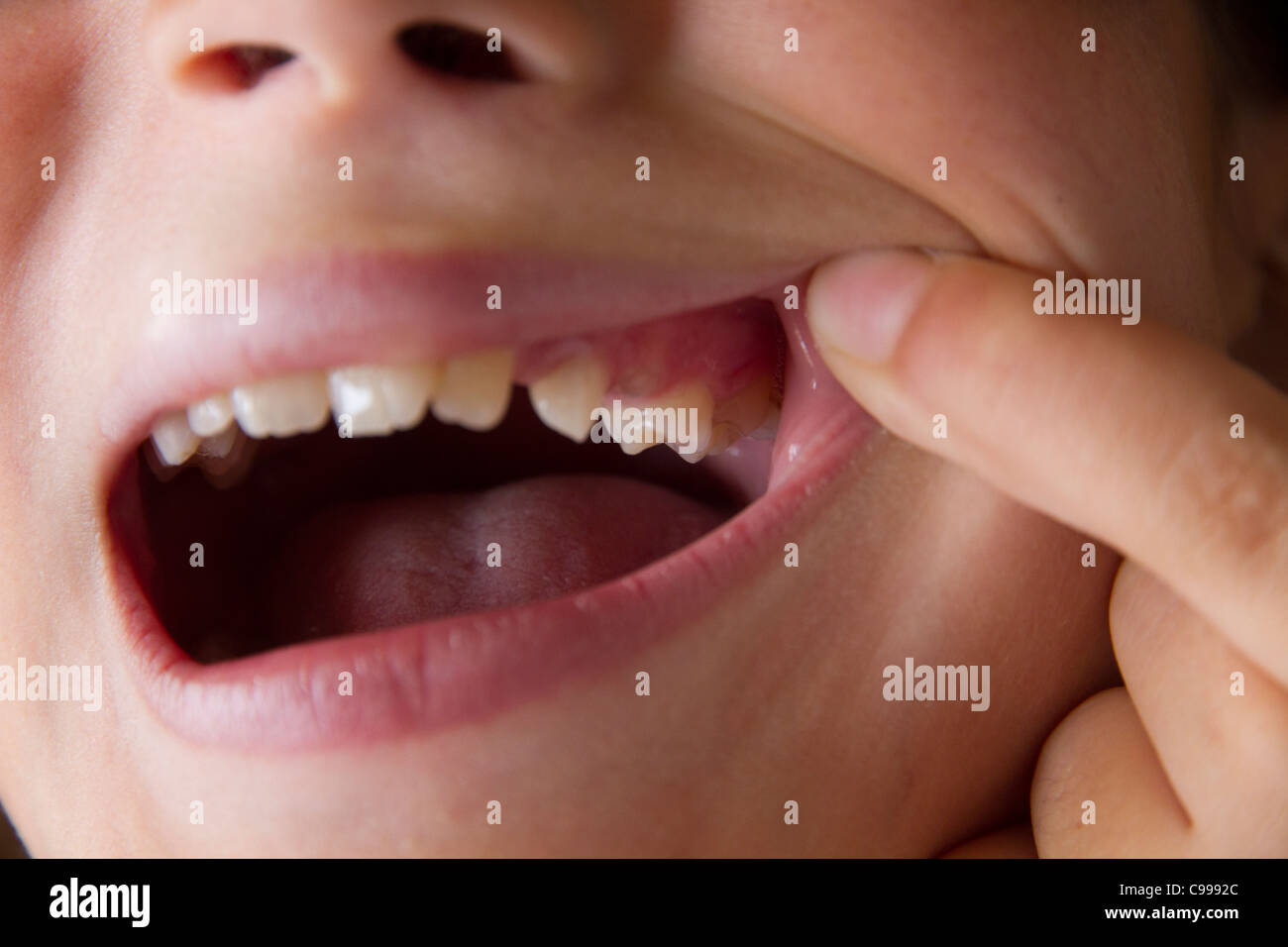 Missing teeth adult hi-res stock photography and images - Alamy