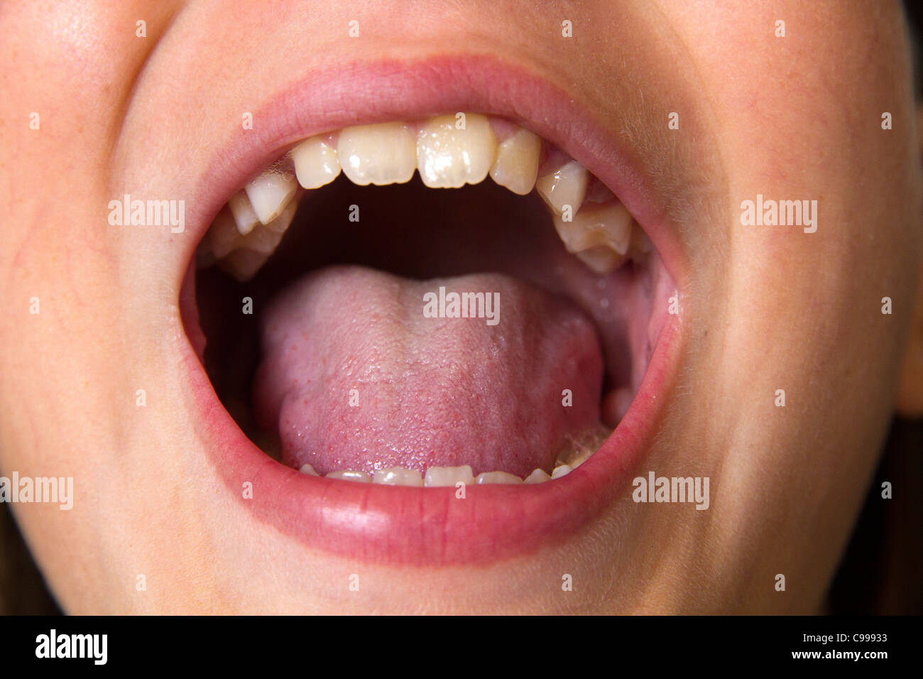 Lost teeth hi-res stock photography and images - Alamy
