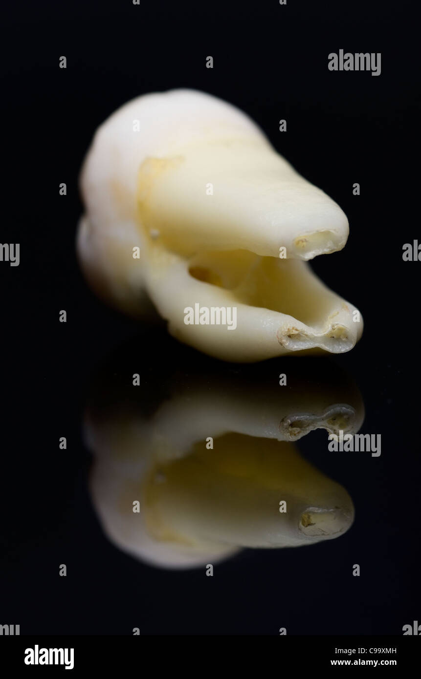 Wisdom tooth on black background, close up Stock Photo - Alamy