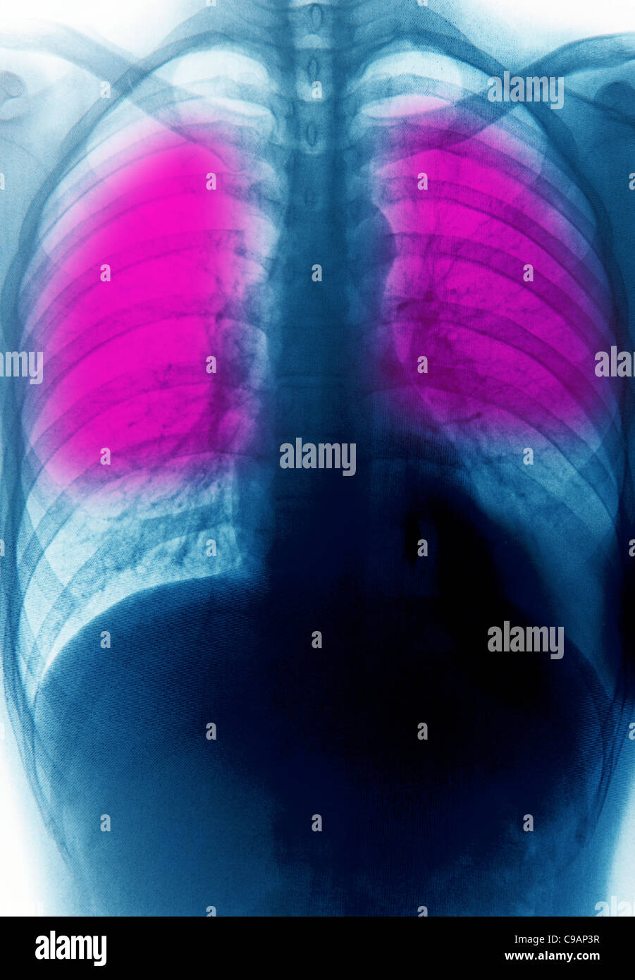 Human lung hi-res stock photography and images - Alamy