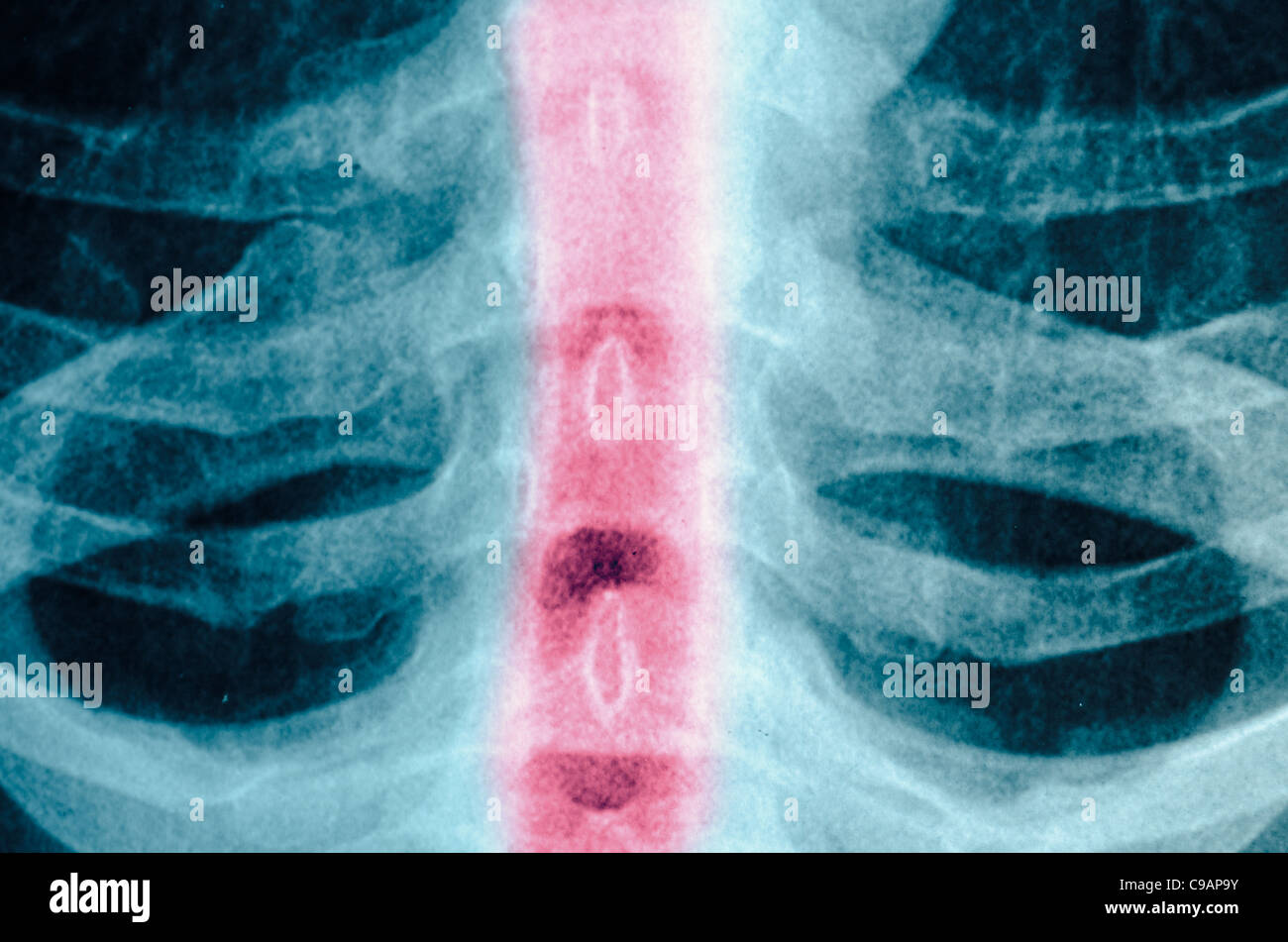 x-ray chest of human bone Stock Photo - Alamy