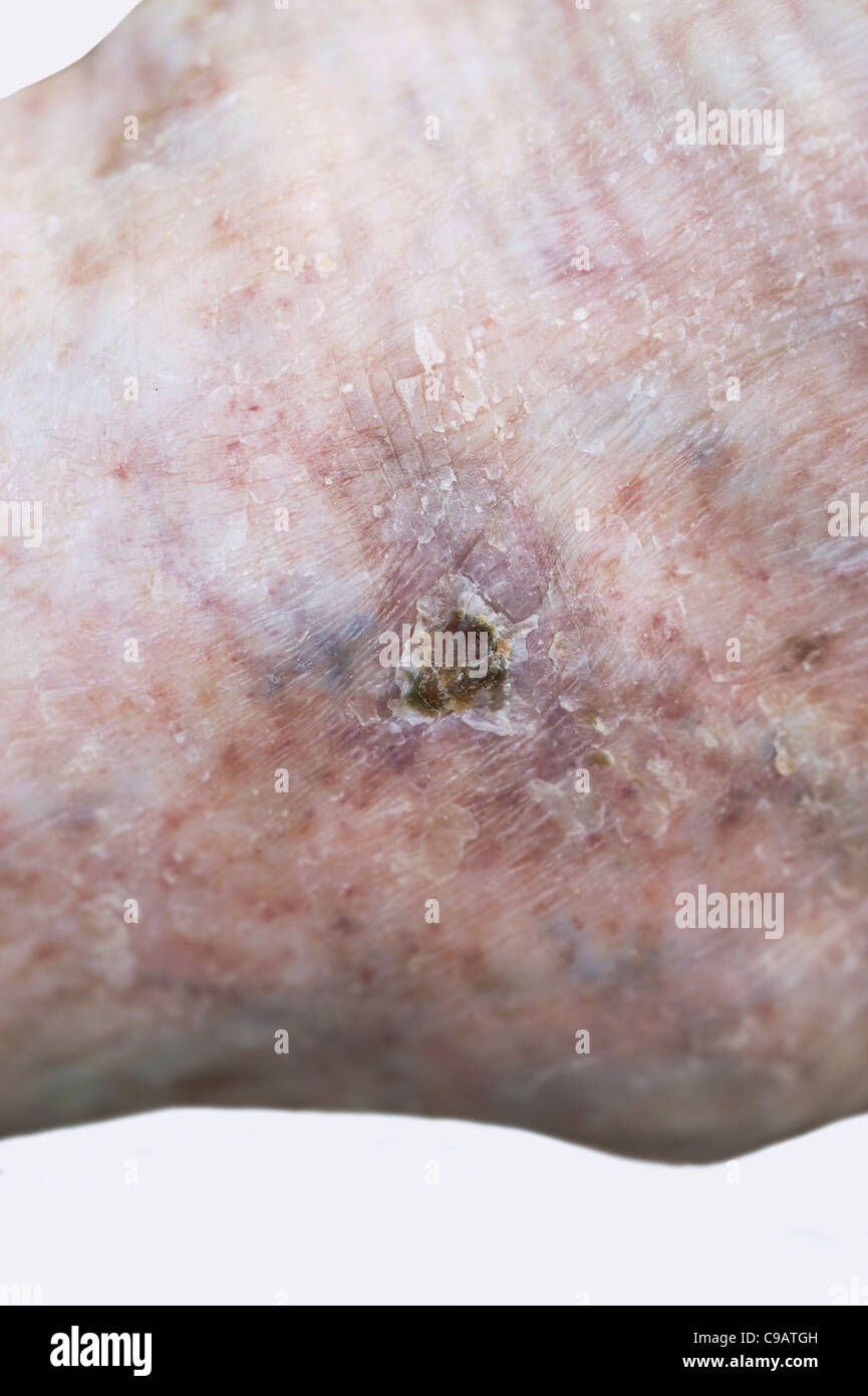 A varicose ulcer situated on a varicose vein Stock Photo - Alamy