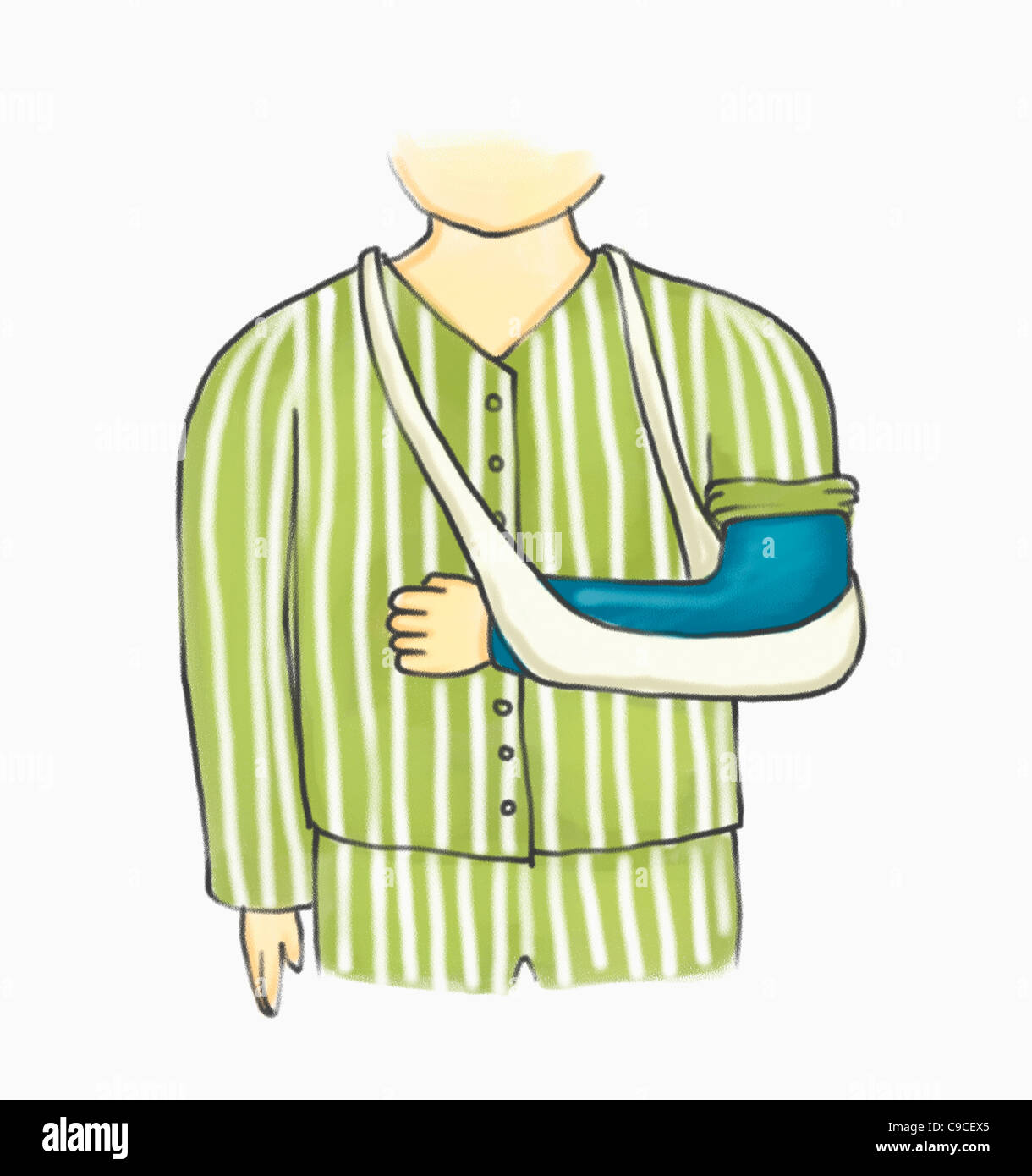Illustration of a patient with broken arm Stock Photo - Alamy