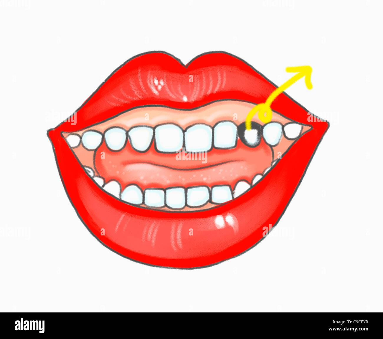 Illustration of a decayed teeth Stock Photo - Alamy