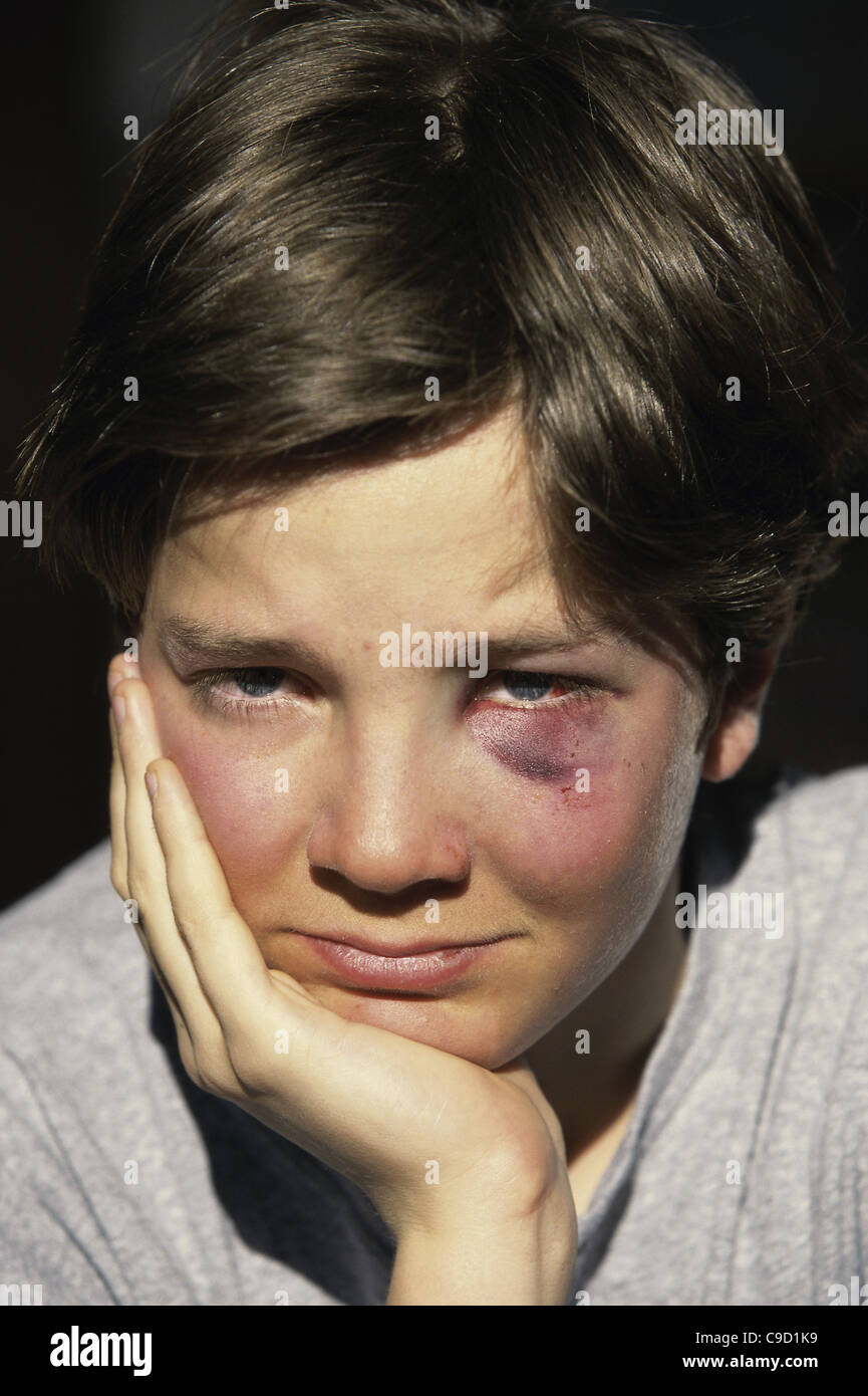 Portrait of a boy with a bruised eye Stock Photo - Alamy