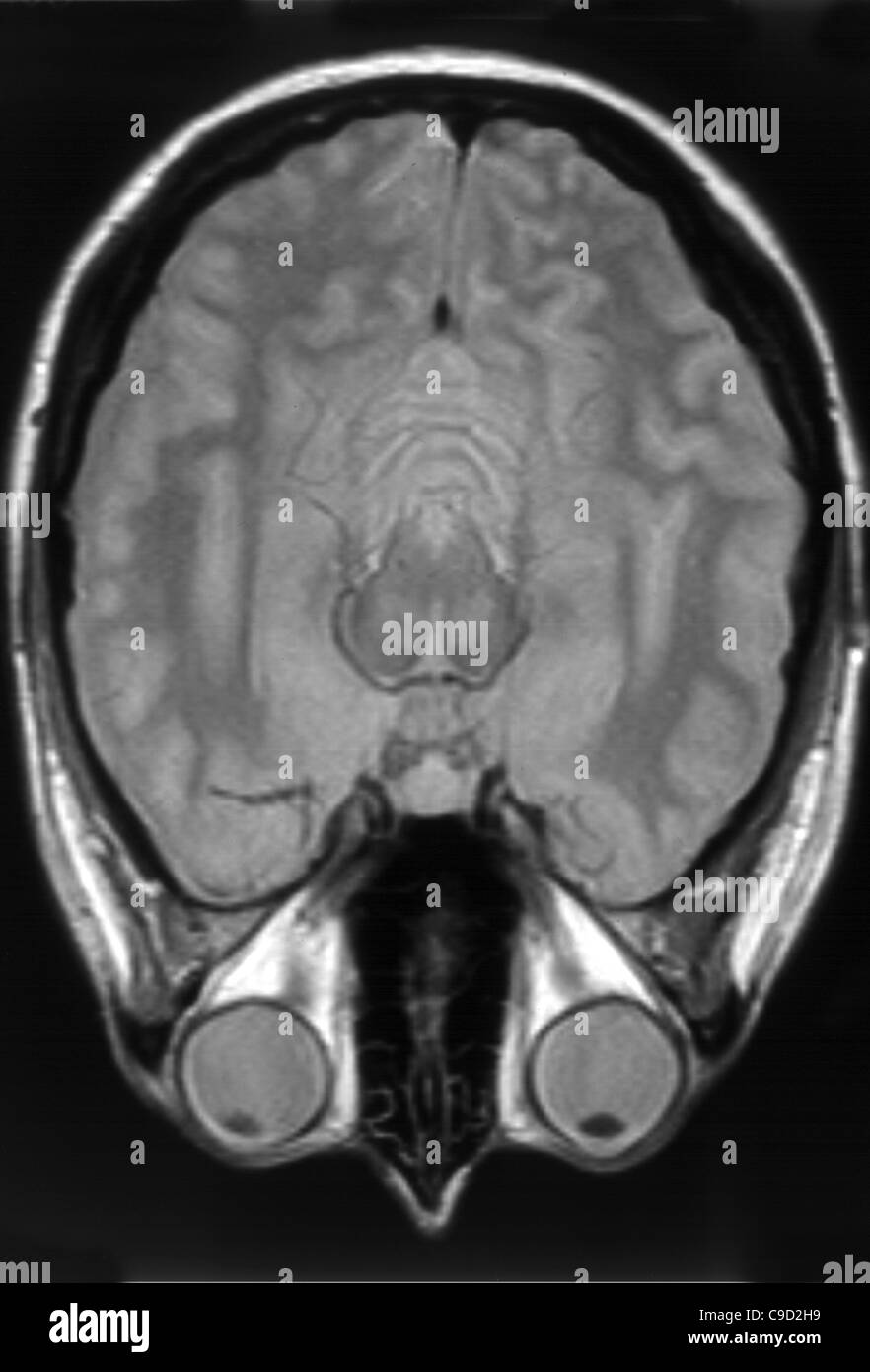 Part of a human brain Black and White Stock Photos & Images - Alamy