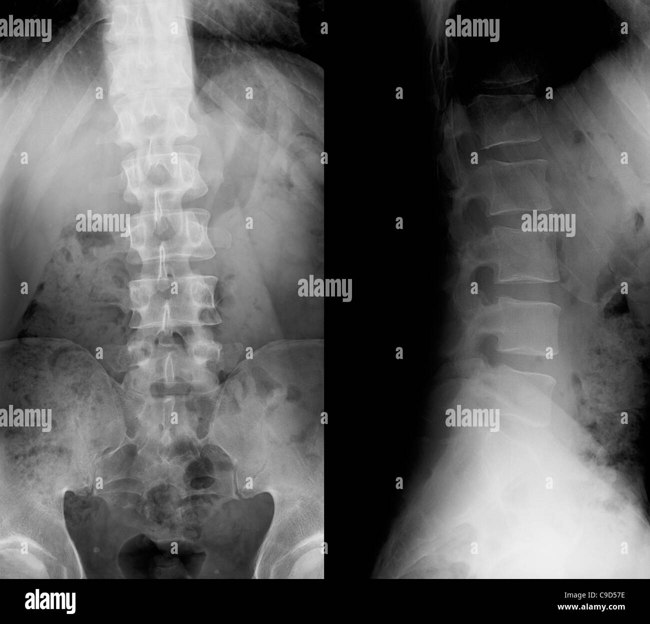 Lumbar ribs hi-res stock photography and images - Alamy