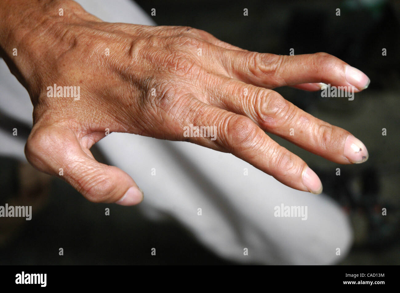 Missing finger hi-res stock photography and images - Alamy