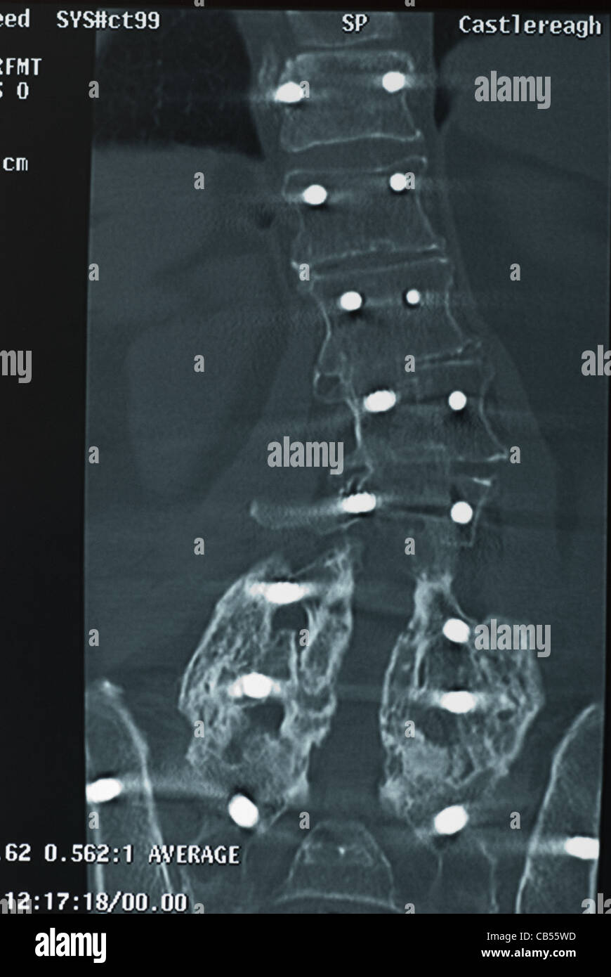 Individual MRI scan of spine and screws Stock Photo - Alamy