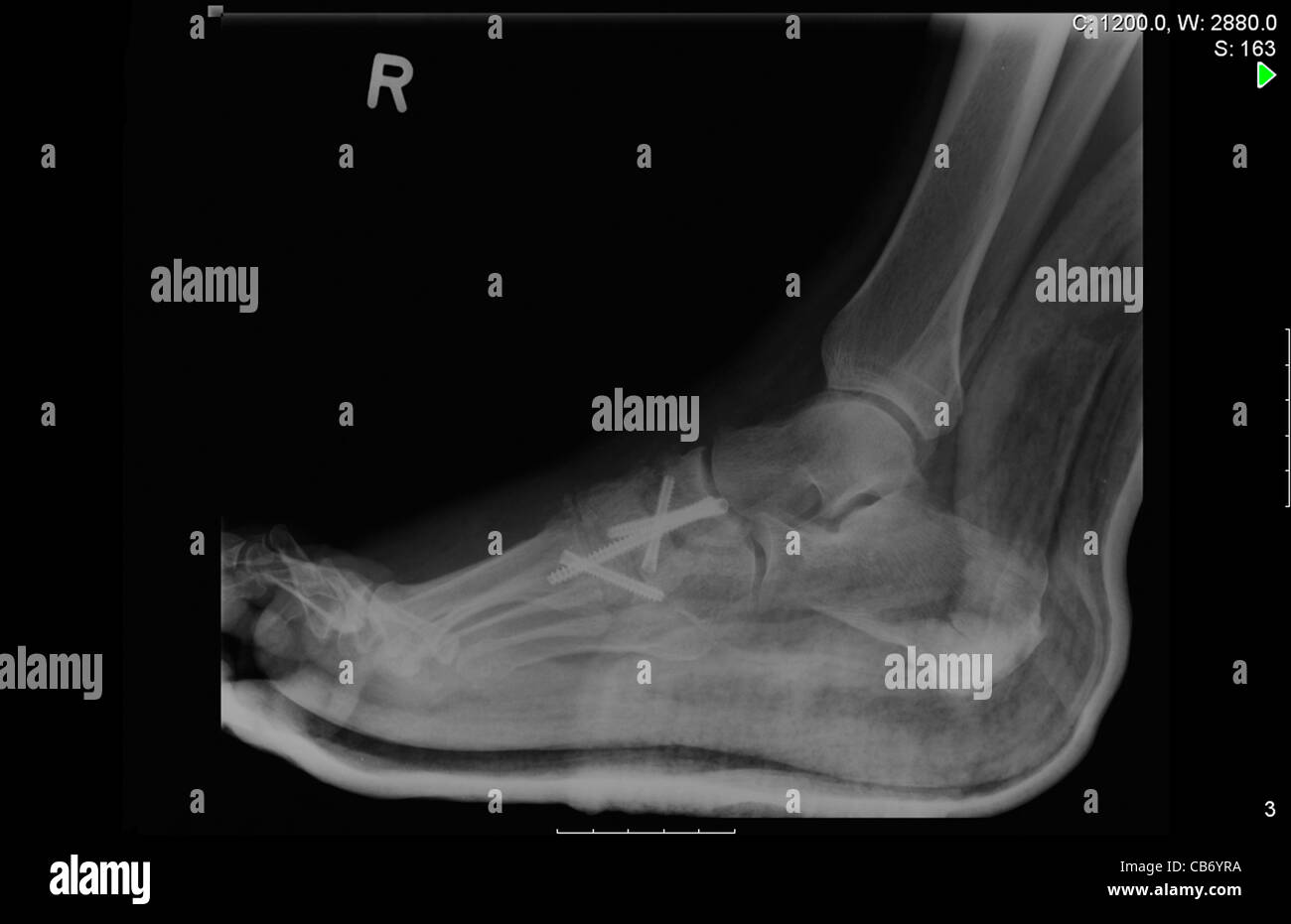 foot and ankle X-ray of a 47 year old male patient suffering from ...