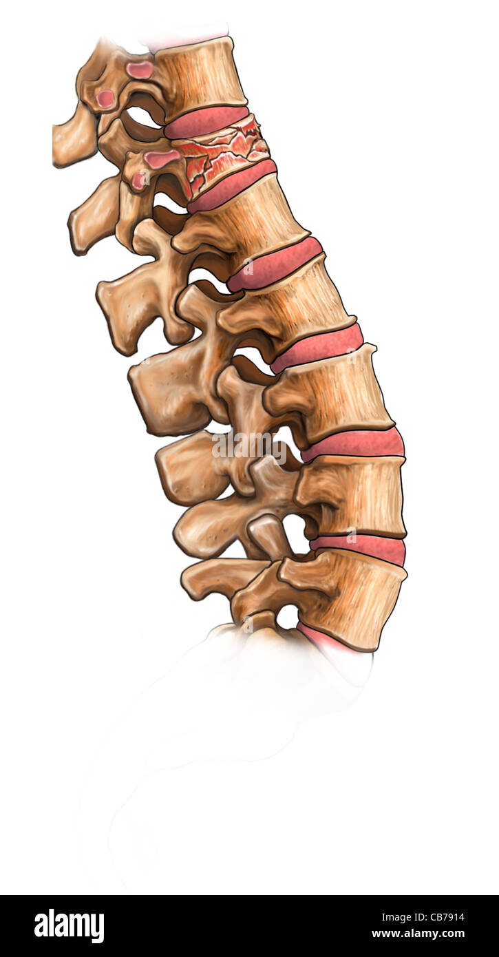 Compression Fracture Diagram