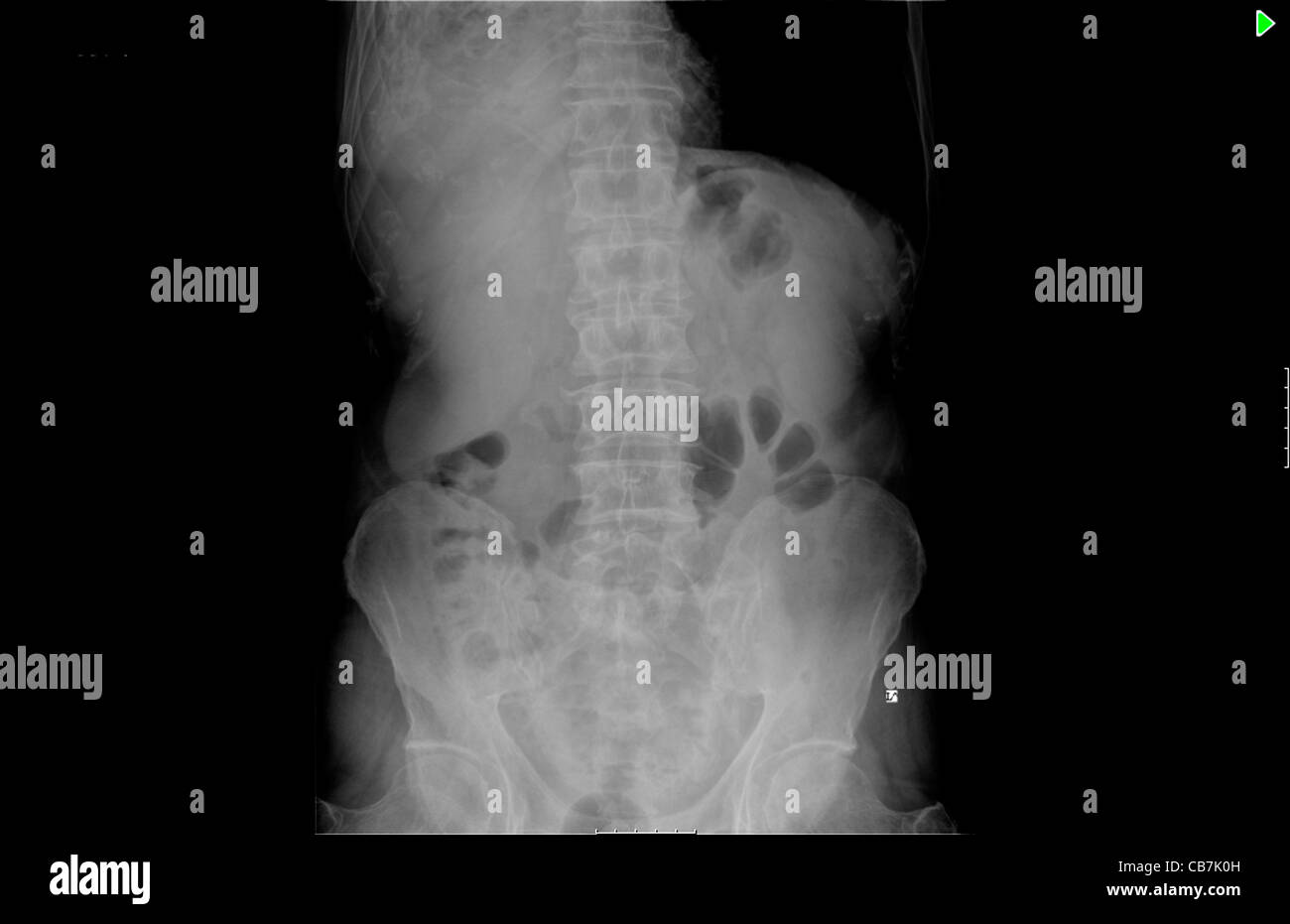 80 Year old male patient. Pelvic X-ray patient suffers from Pleurisy ...