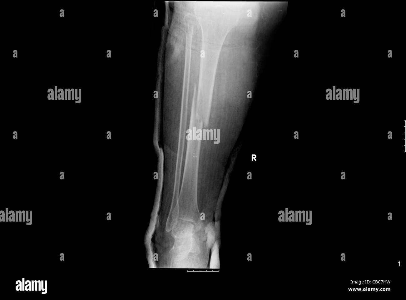 54 year old patient with a fracture of the Tibia and Fibula Stock Photo ...