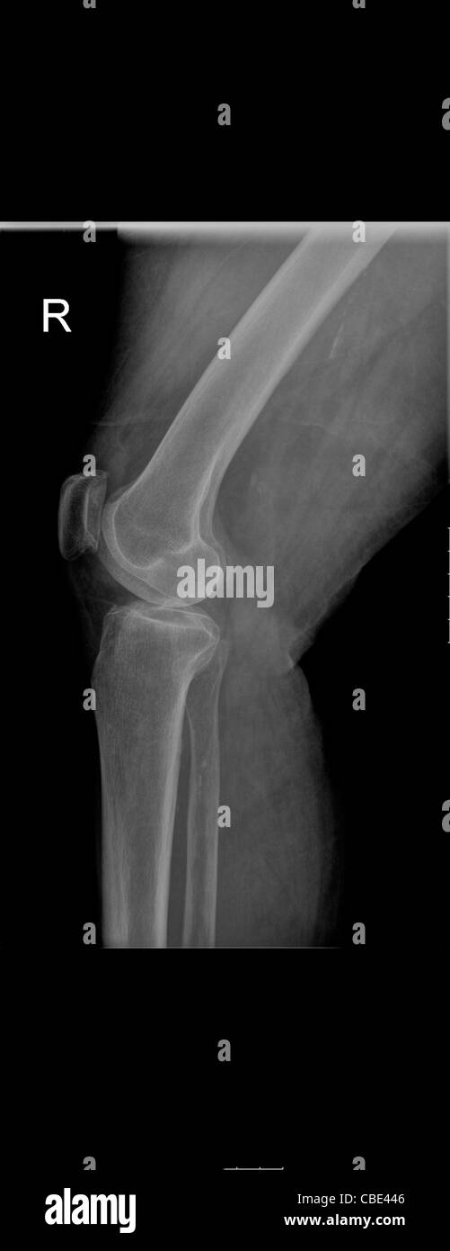 Chondrocalcinosis Vs Normal
